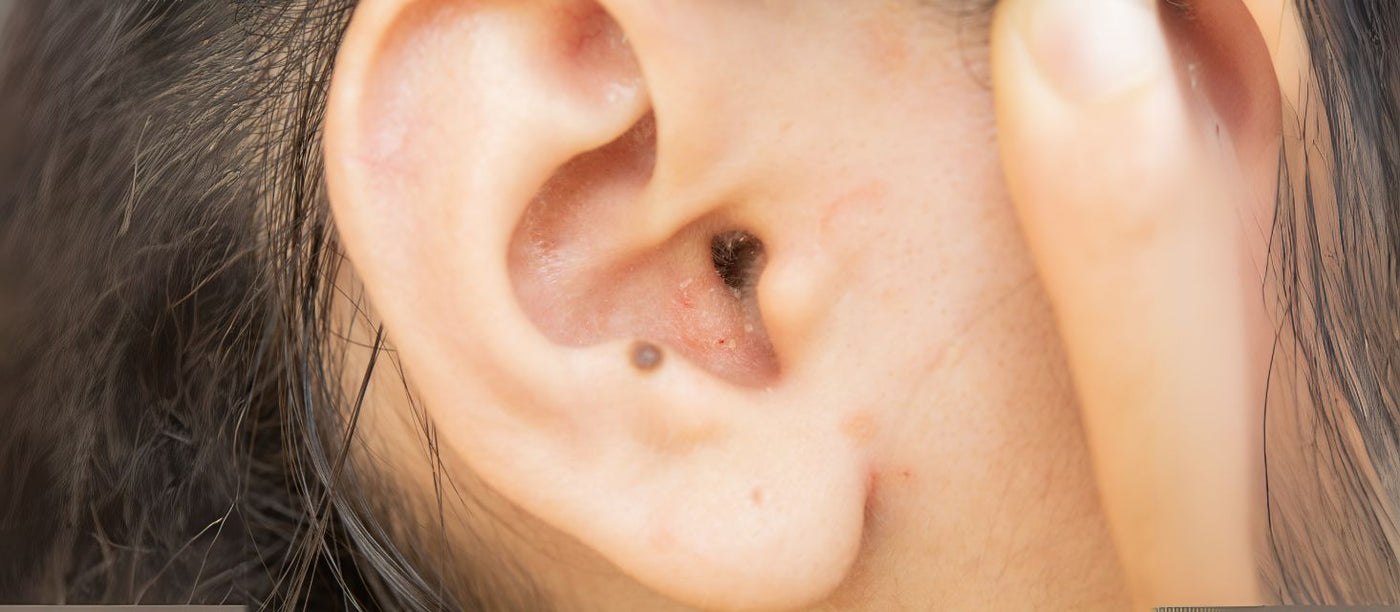 Dry Skin Inside Ears: Causes, Treatments, and Prevention – Auracle